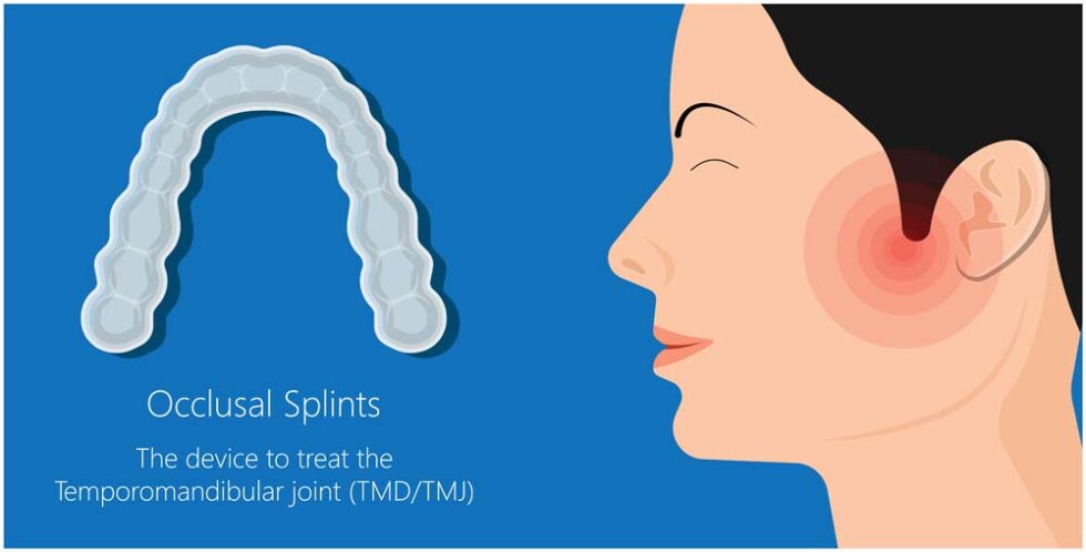 TMJ (Tempro-Mandibular Joint Dysfunction) - Castle Orthodontics